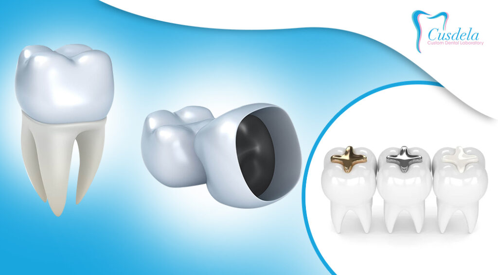 Full Metal Crown: Pros and Cons of Full Metal Crown. | Blog